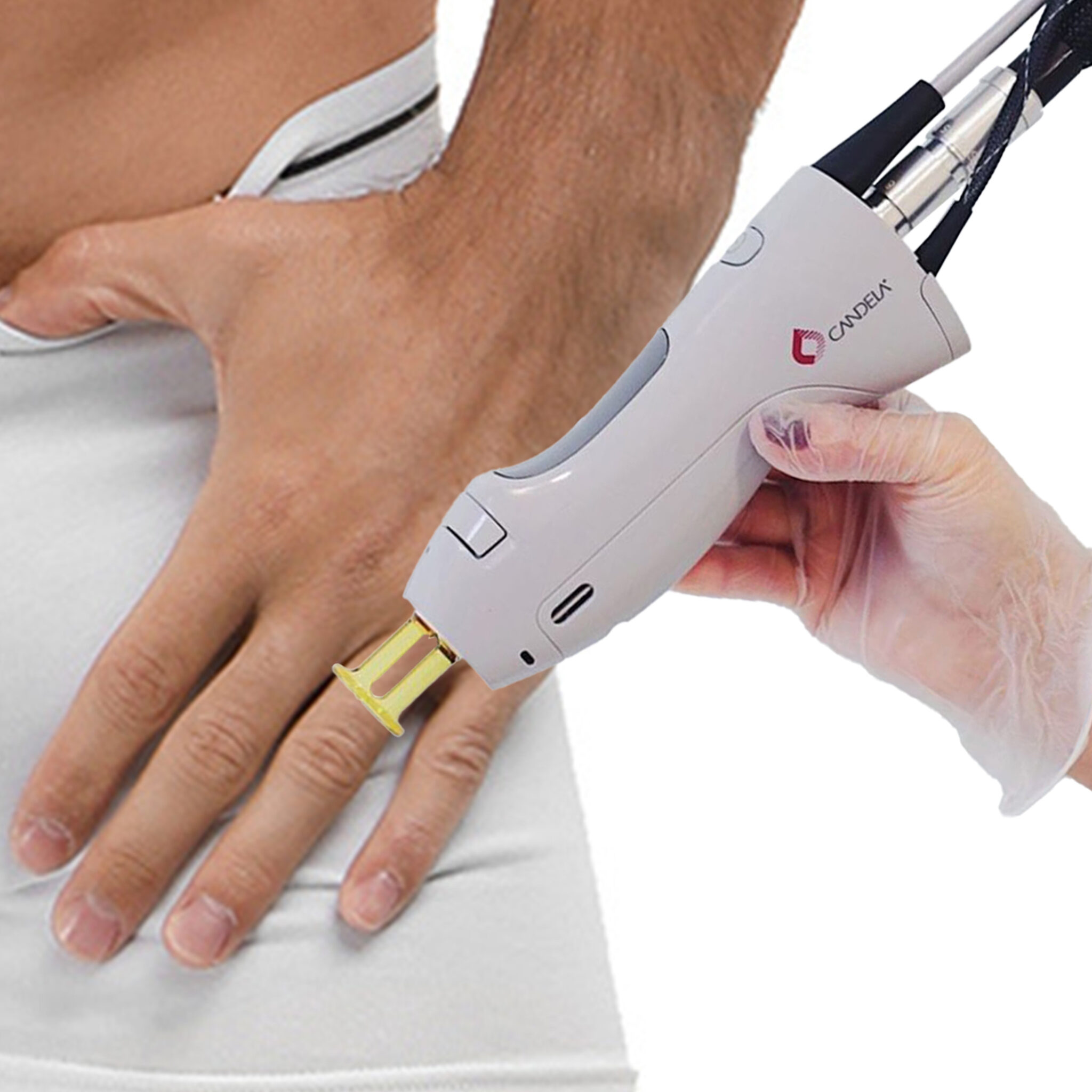 Laser hair removal on fingers - price